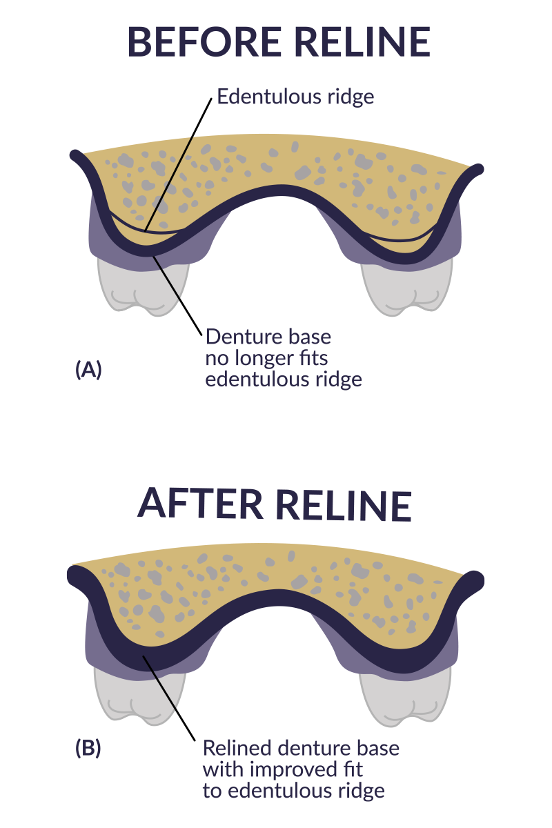 Repair & Reline Dentures in Fort McMurray