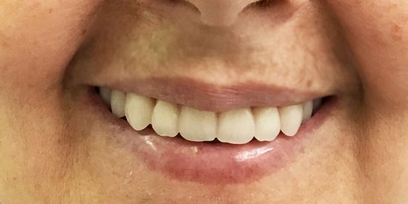 About CustomFit Denture Clinic in Fort Mac